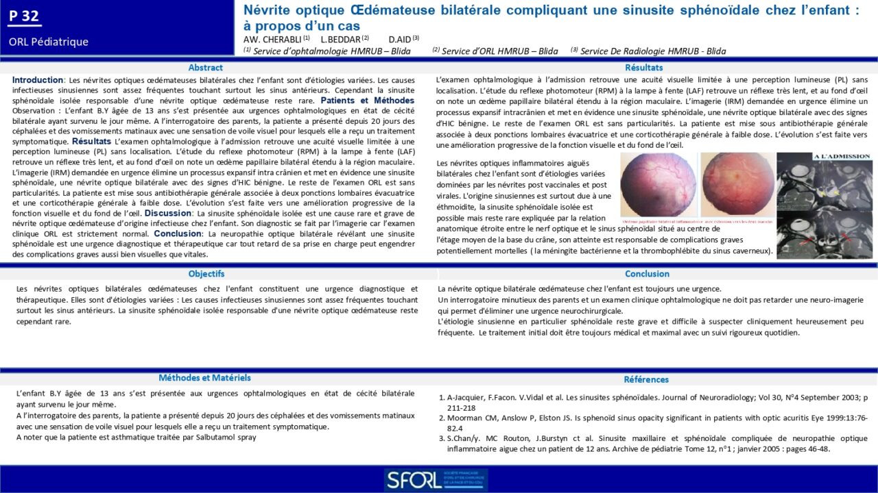 Névrite optique Œdémateuse bilatérale compliquant une sinusite ...