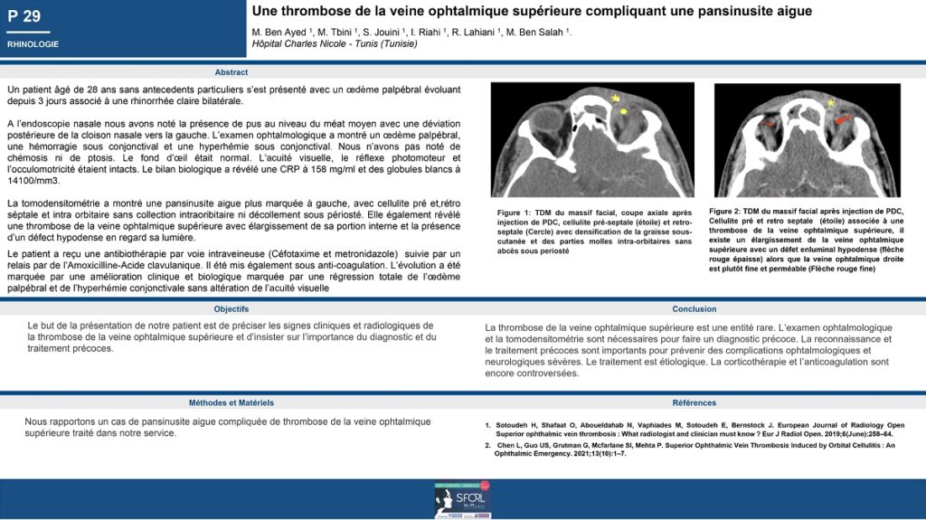 Une thrombose de la veine ophtalmique supérieure compliquant une ...