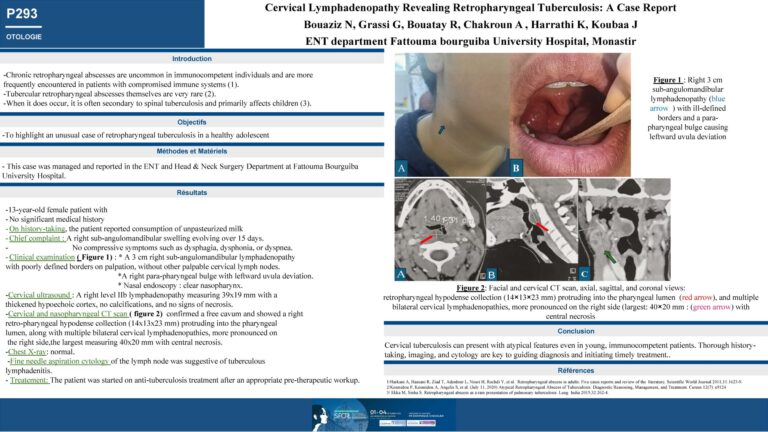 P293 – Cervical Lymphadenopathy Revealing Retropharyngeal Tuberculosis ...