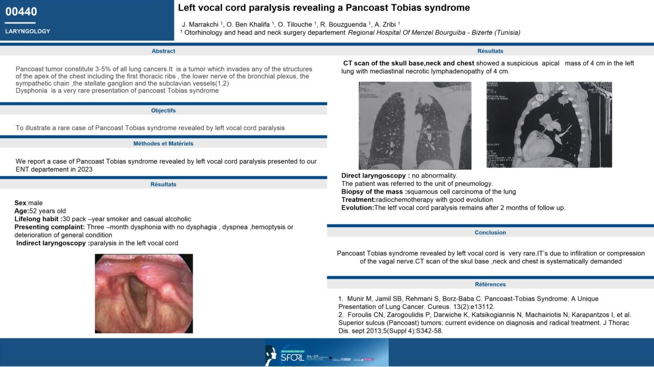 Left vocal cord paralysis revealing a Pancoast Tobias syndrome – La ...